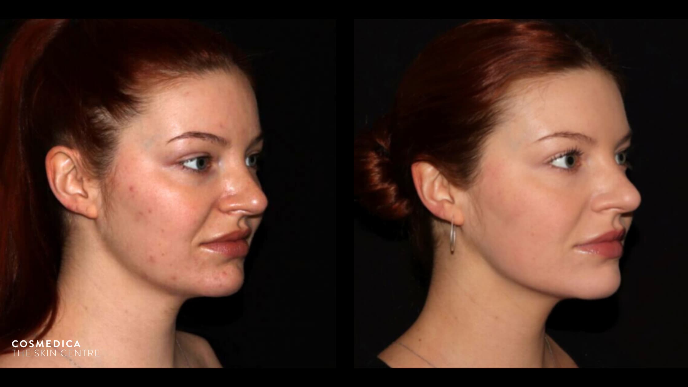 Morpheus 8 Before and After [Real Photos Included]