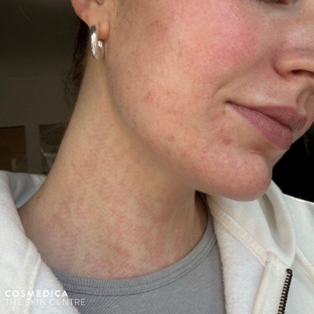 Morpheus 8 Before and After [Real Photos Included]